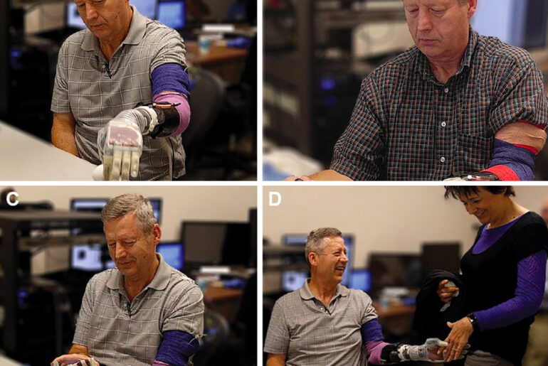 Innovative Prosthetic Arm Restores Sense of Touch to Amputees, is Luke ...