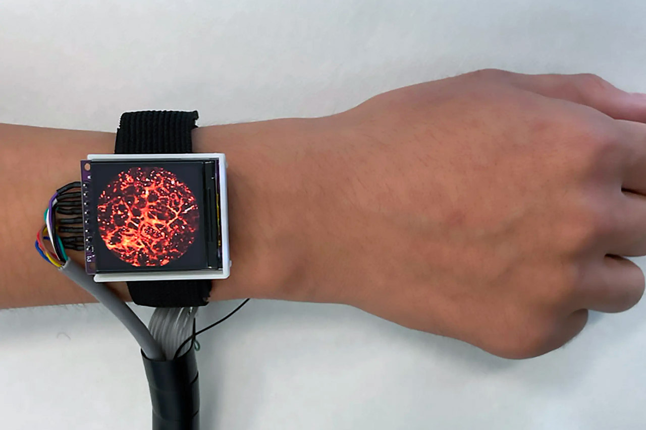 Wearable Photoacoustic Imaging Watch Lets You See the Blood Vessels in ...
